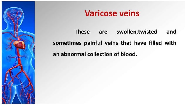 DVT and Vericose Vein and it causes and treatment | PPT