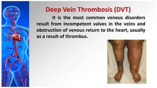 DVT and Vericose Vein and it causes and treatment | PPTX