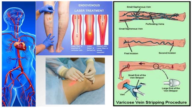 DVT and Vericose Vein and it causes and treatment | PPT