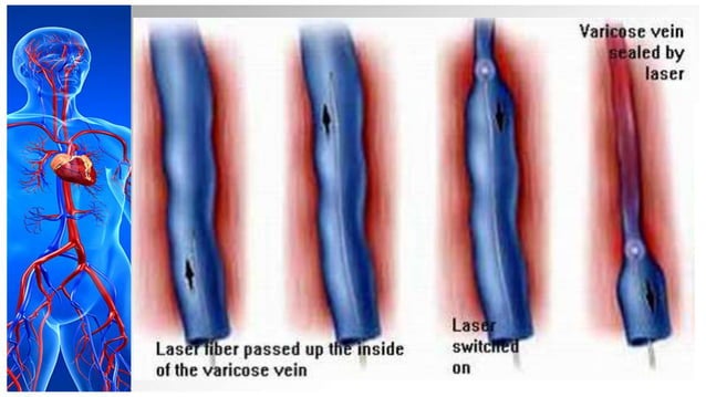 DVT and Vericose Vein and it causes and treatment | PPT