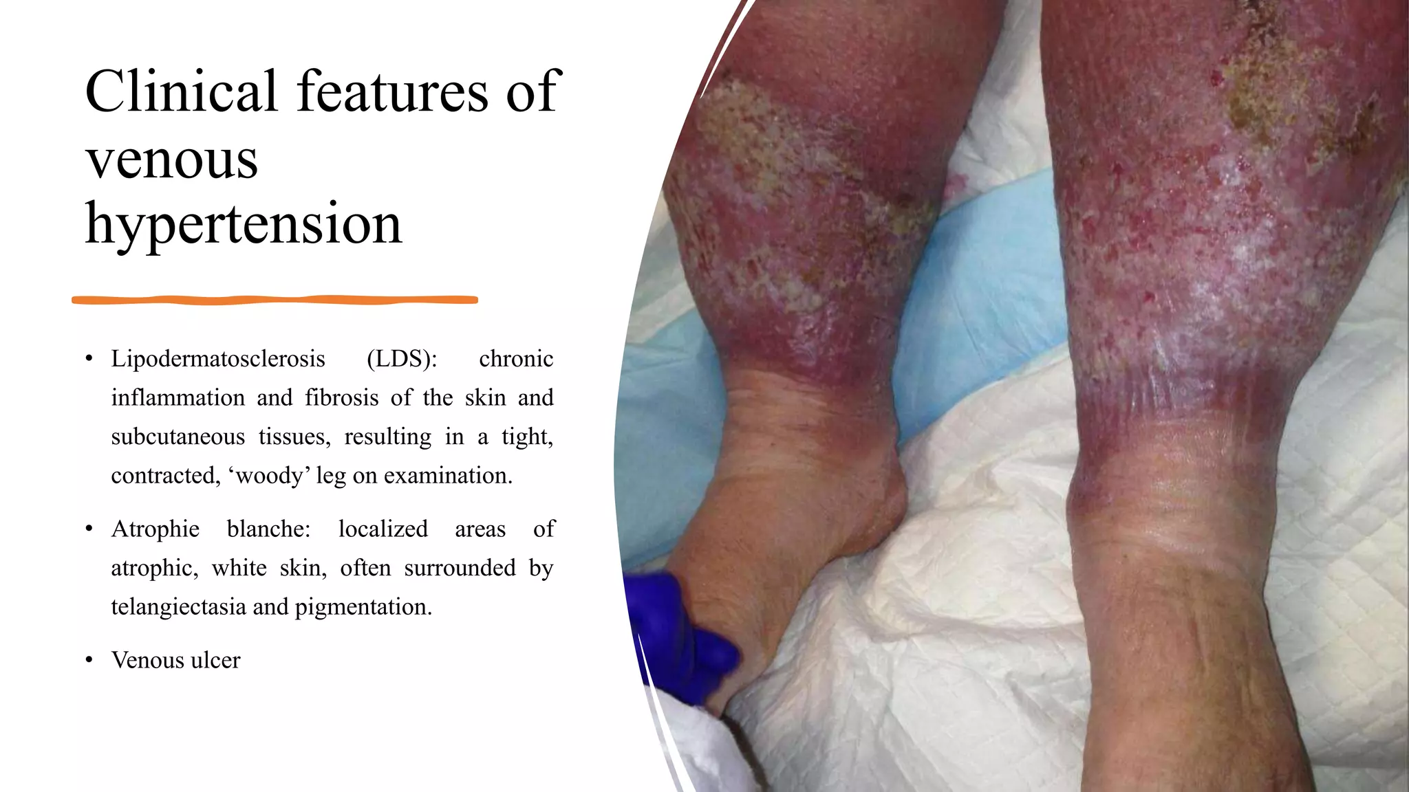 Varicose Veins and Deep Vein Thrombosis | PPTX