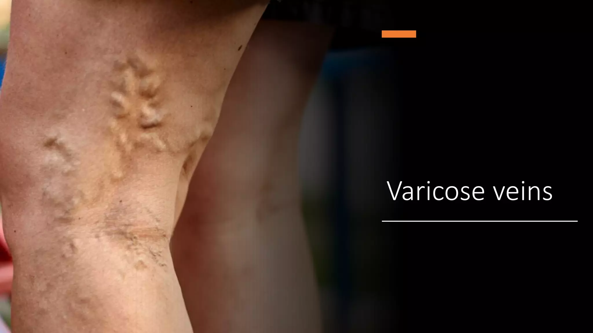 Varicose Veins and Deep Vein Thrombosis | PPTX