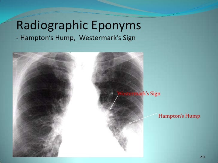 Dvt in malignancy pre