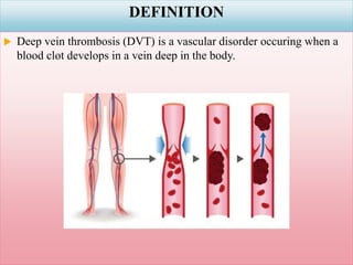 DVT (MSN).pptx