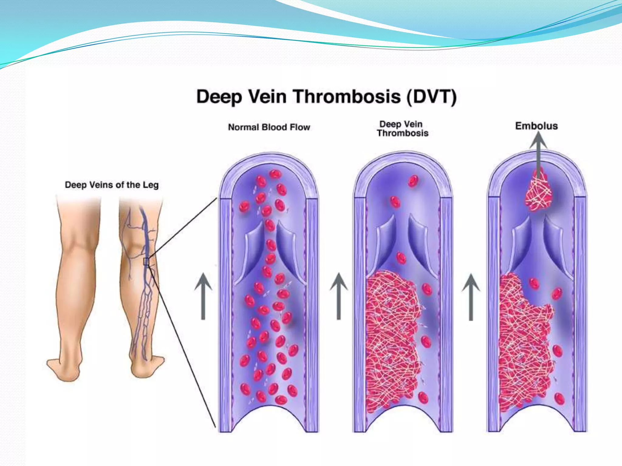 DVT, PE and Stroke: What's the Difference? | PPTX