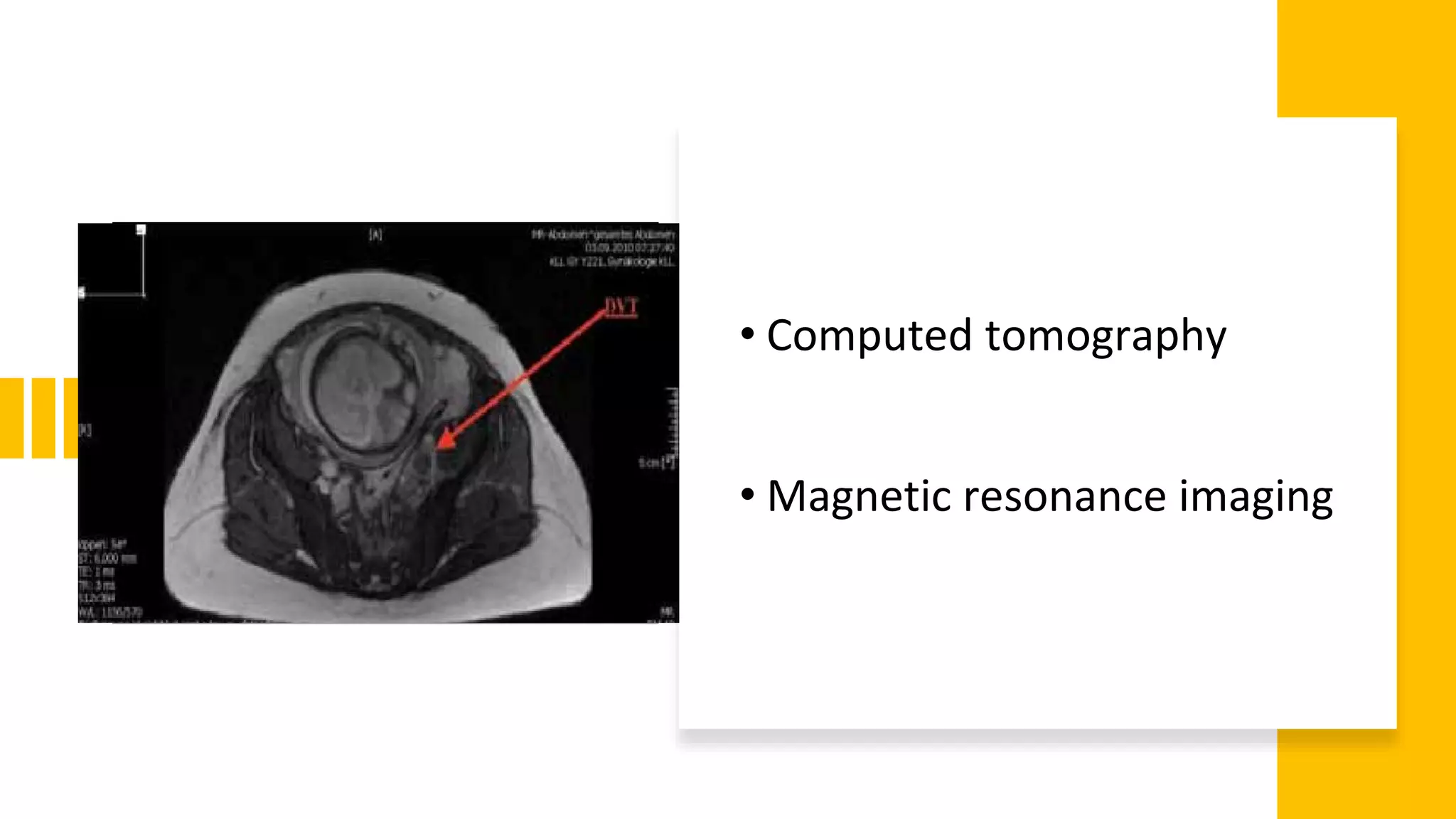 Dvt prophylaxis in orthopaedic surgery | PPTX