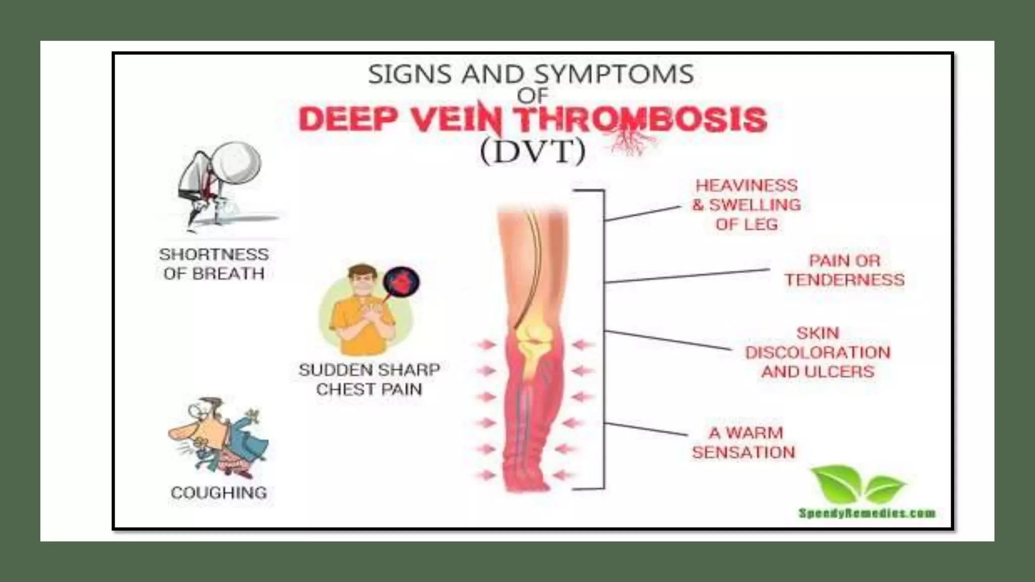 Dvt prophylaxis , treatment and anaesthetic considerations | PPTX
