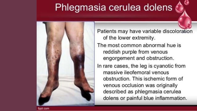 Dvt prophylaxis , treatment and anaesthetic considerations | PPTX ...