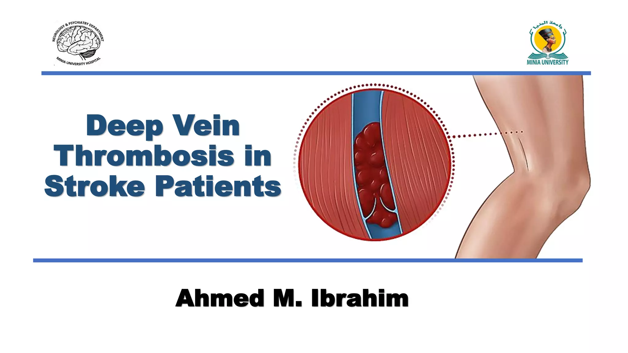 Deep Vein Thrombosis in stroke patients | PDF