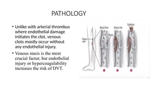 DVT-definition-clinical pictures- management | PPT