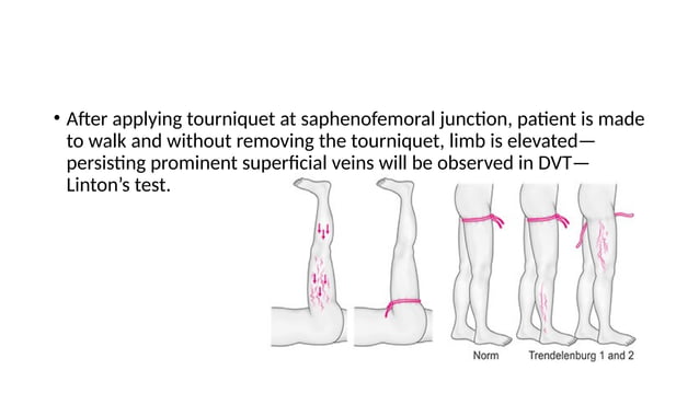 DVT-definition-clinical pictures- management | PPTX