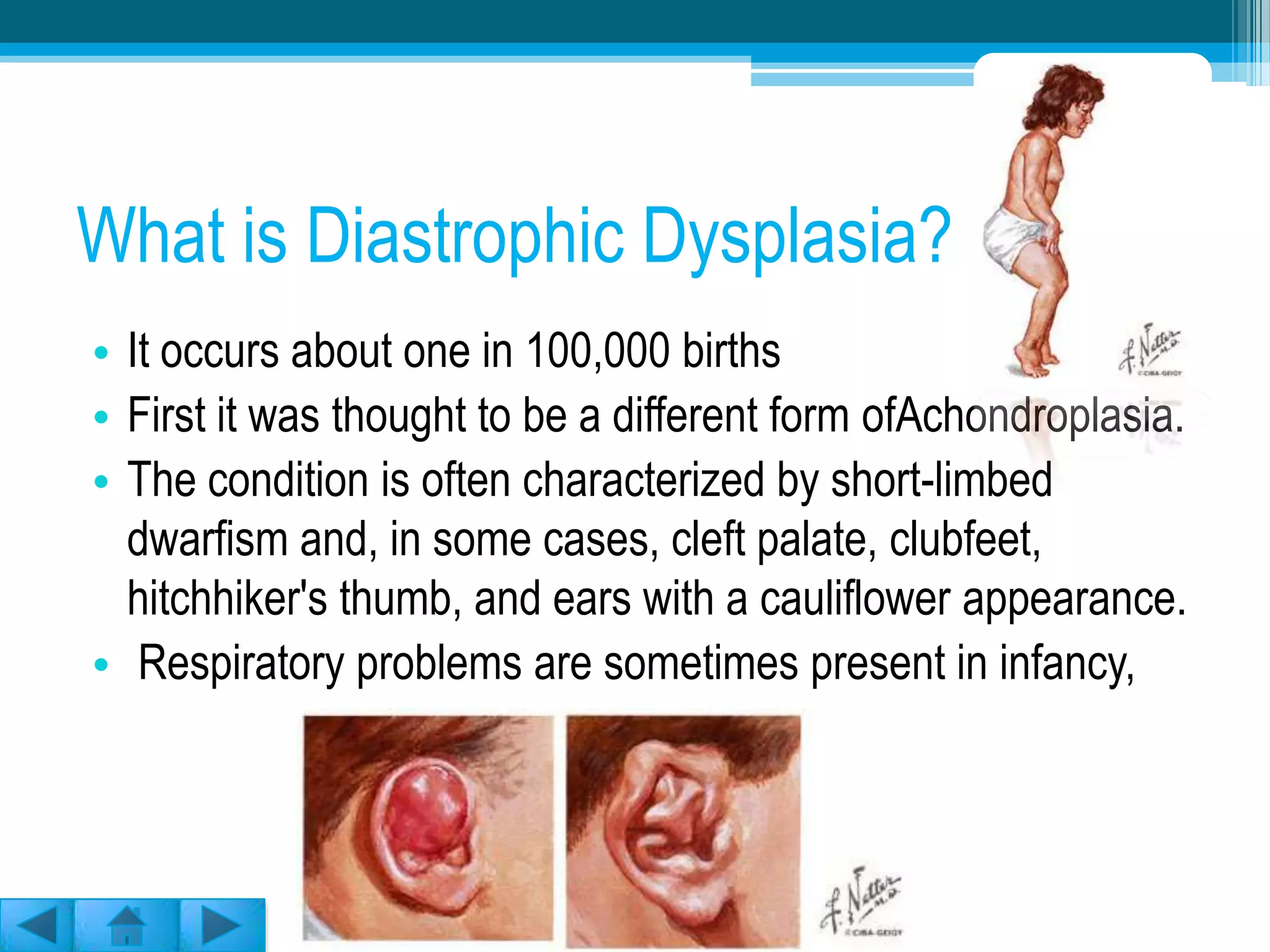 Dwarfism | PPTX