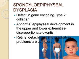 Spondyloepiphyseal Dysplasia Dwarfism