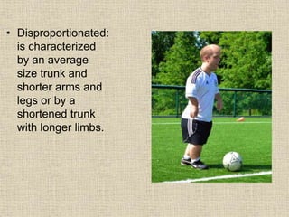Dwarfism | PPT