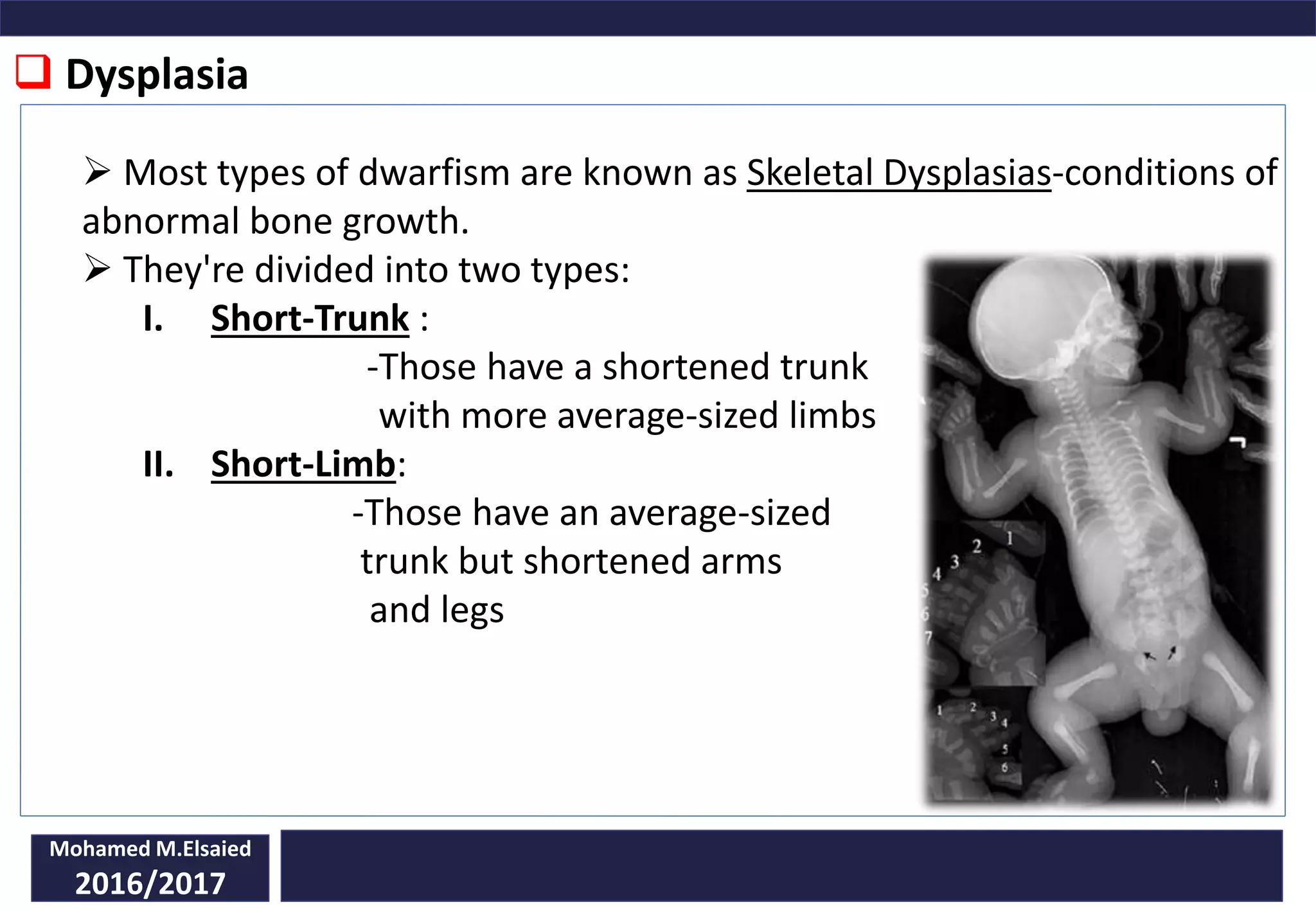 Dwarfism | PPTX
