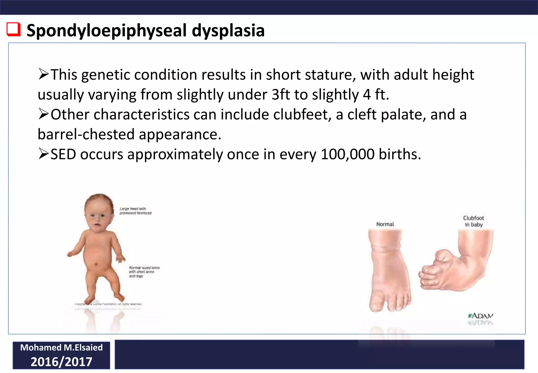 Dwarfism | PPTX