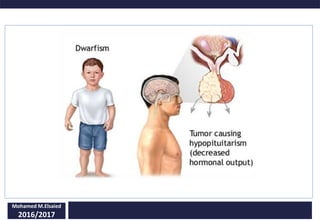 Dwarfism | PPTX