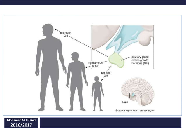 Dwarfism | PPTX | Endocrine and Metabolic Diseases | Diseases and ...