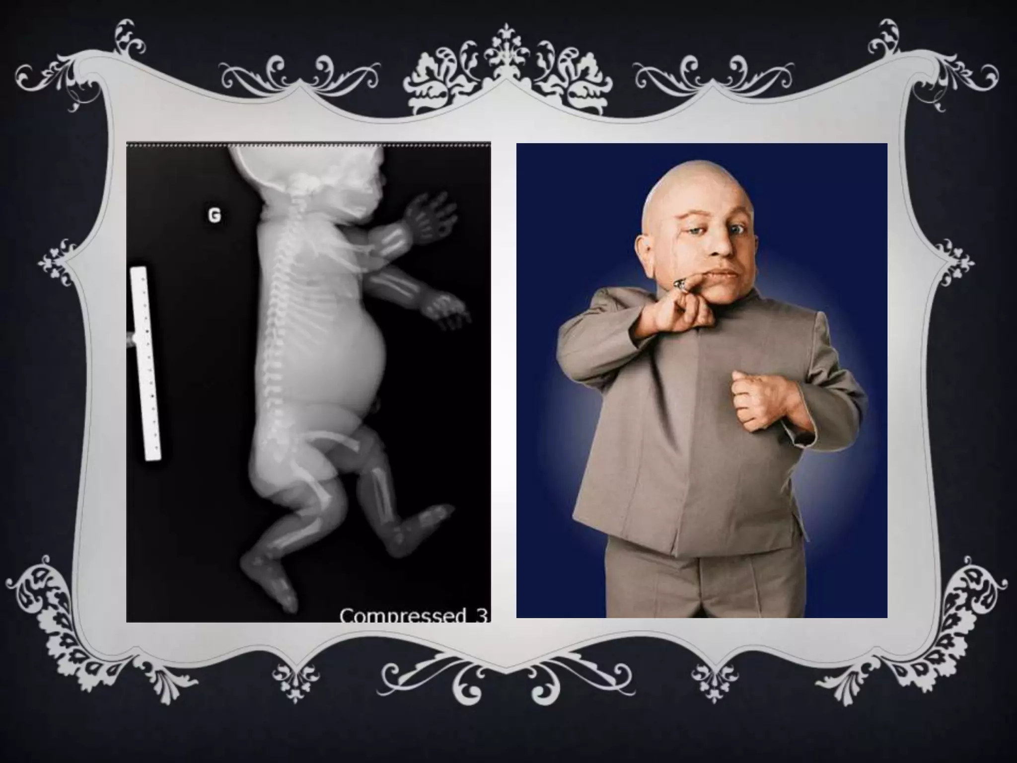 Dwarfism 2 | PPTX