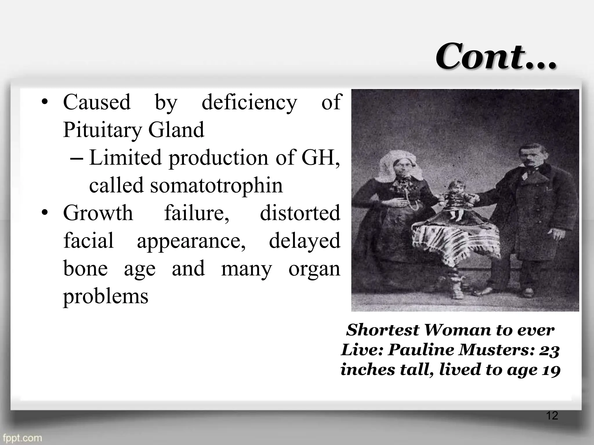 DWARFISM,GIGANTISM and sign symptoms,causes | PPTX