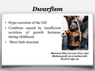 DWARFISM,GIGANTISM and sign symptoms,causes | PPTX