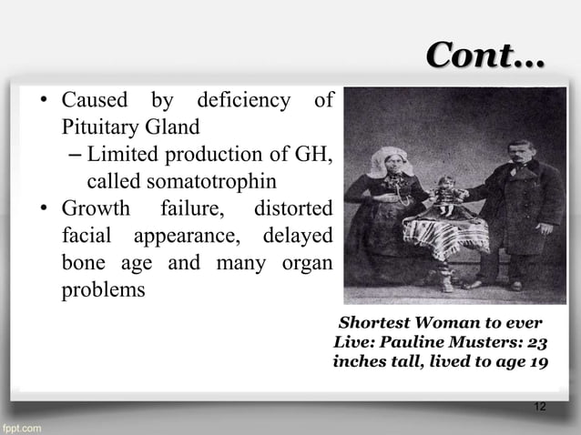 DWARFISM,GIGANTISM and sign symptoms,causes | PPT