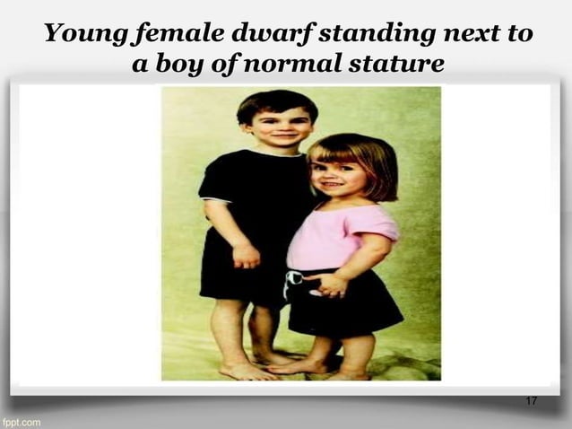 DWARFISM,GIGANTISM and sign symptoms,causes | PPT