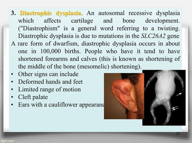 DWARFISM,GIGANTISM and sign symptoms,causes | PPT