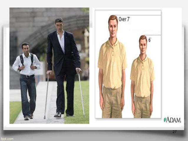 DWARFISM,GIGANTISM and sign symptoms,causes | PPT
