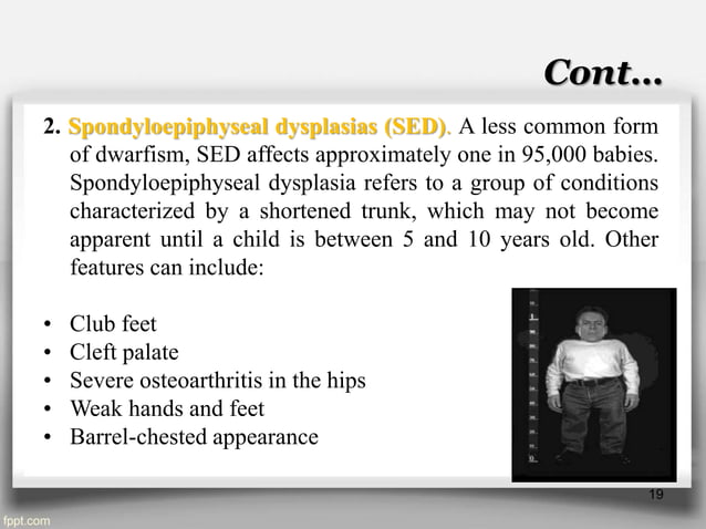 Dwarfism, Gigantism and Acromegaly, Educational Platform.ppt ...