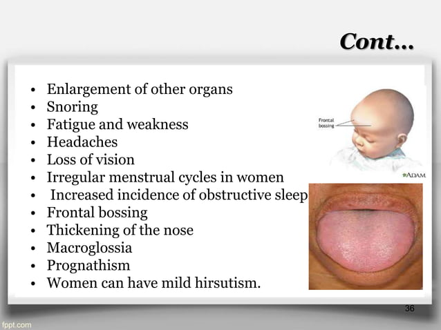Dwarfism, Gigantism and Acromegaly, Educational Platform.ppt ...
