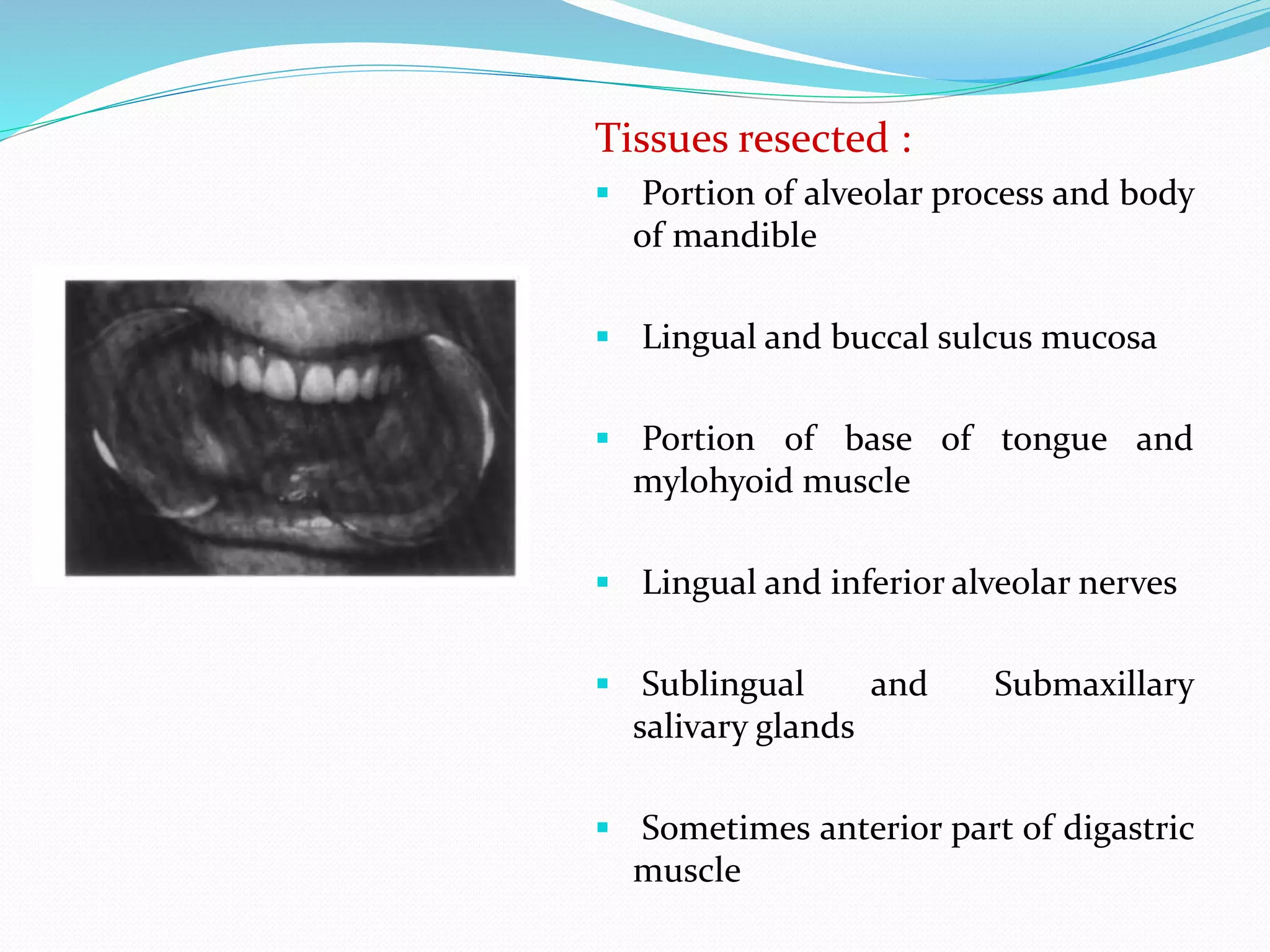 Management of aquired mandibular defect / mandible defect management | PPTX