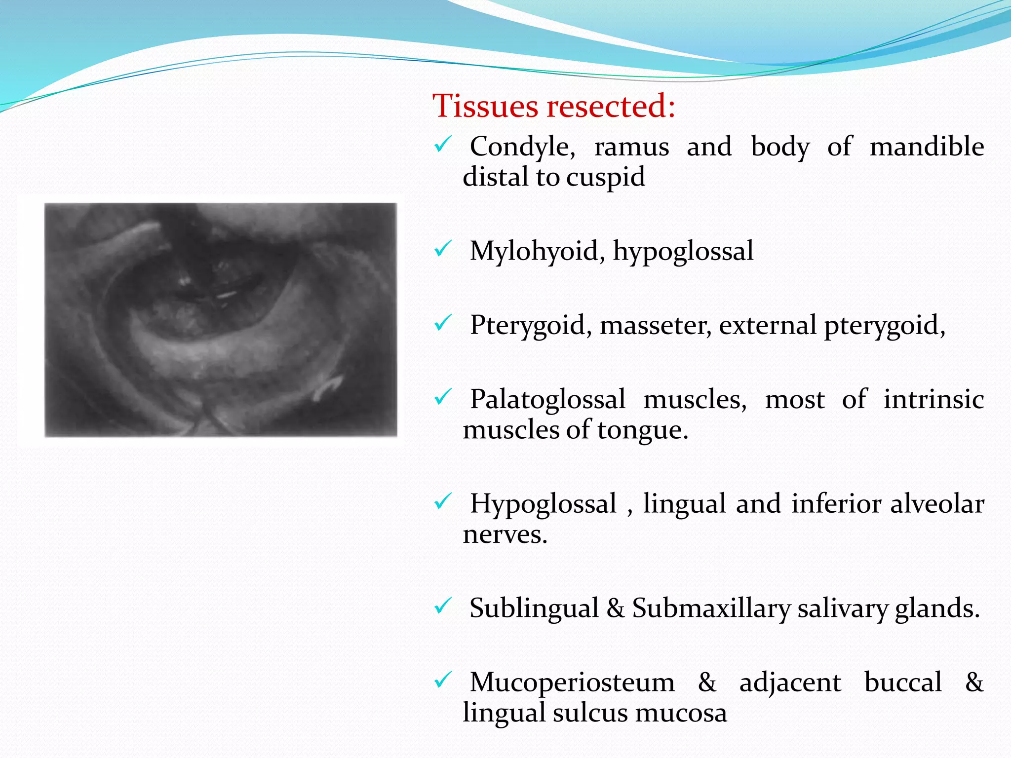 Management of aquired mandibular defect / mandible defect management | PPTX