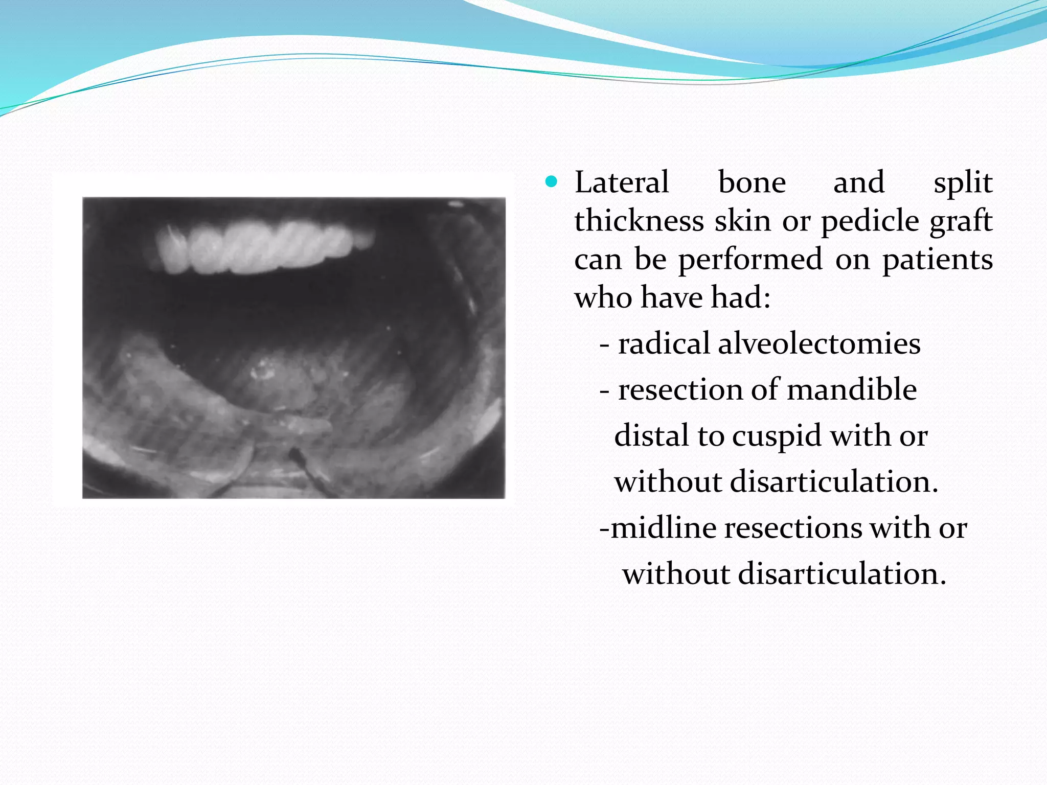 Management of aquired mandibular defect / mandible defect management | PPTX