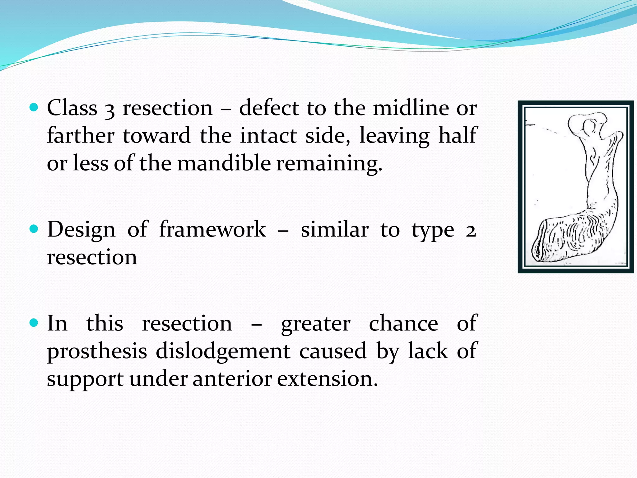 Management of aquired mandibular defect / mandible defect management | PPTX