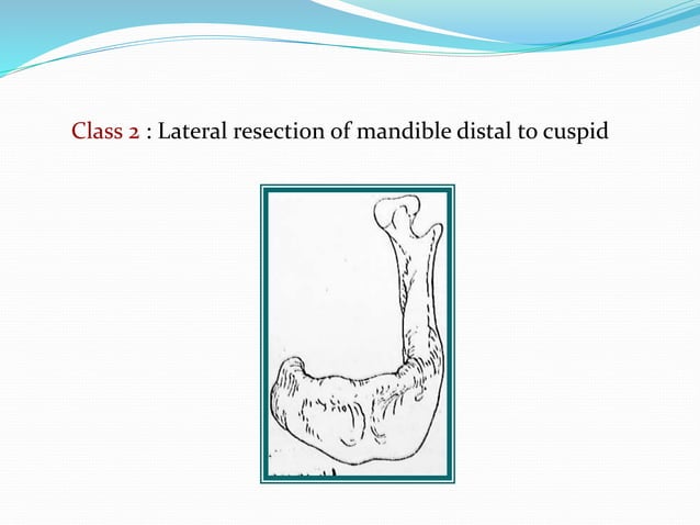 Management of aquired mandibular defect / mandible defect management | PPTX