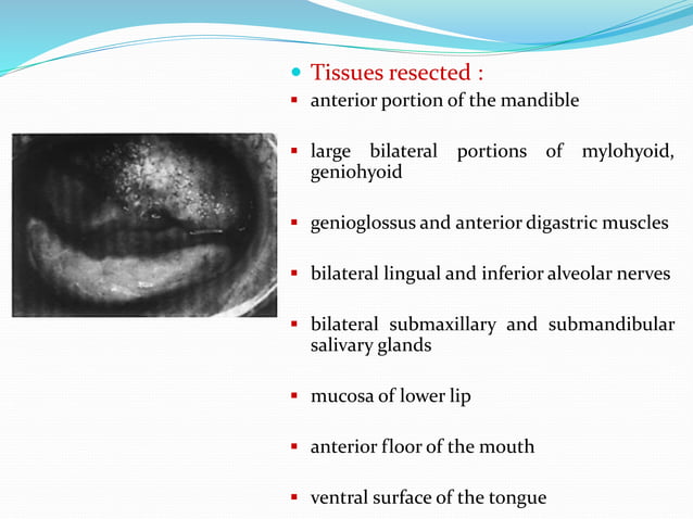 Management of aquired mandibular defect / mandible defect management | PPTX