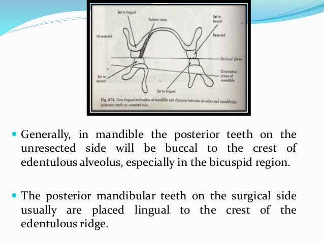 Management of aquired mandibular defect / mandible defect management