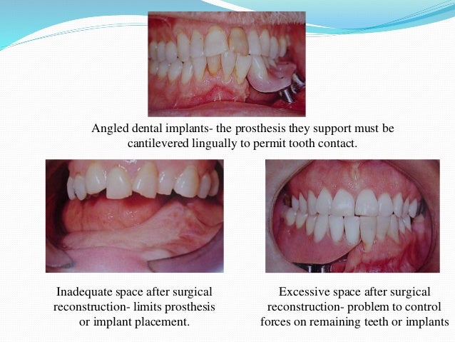 Management of aquired mandibular defect / mandible defect management
