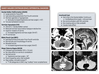 Dandy-Walker Malformation: Classification and Management | PPTX