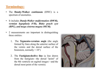 Dandy-Walker Malformation: Classification and Management | PPTX