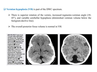 Dandy-Walker Malformation: Classification and Management | PPTX