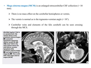 Dandy-Walker Malformation: Classification and Management | PPTX