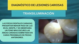 DX CARIES. | PPTX