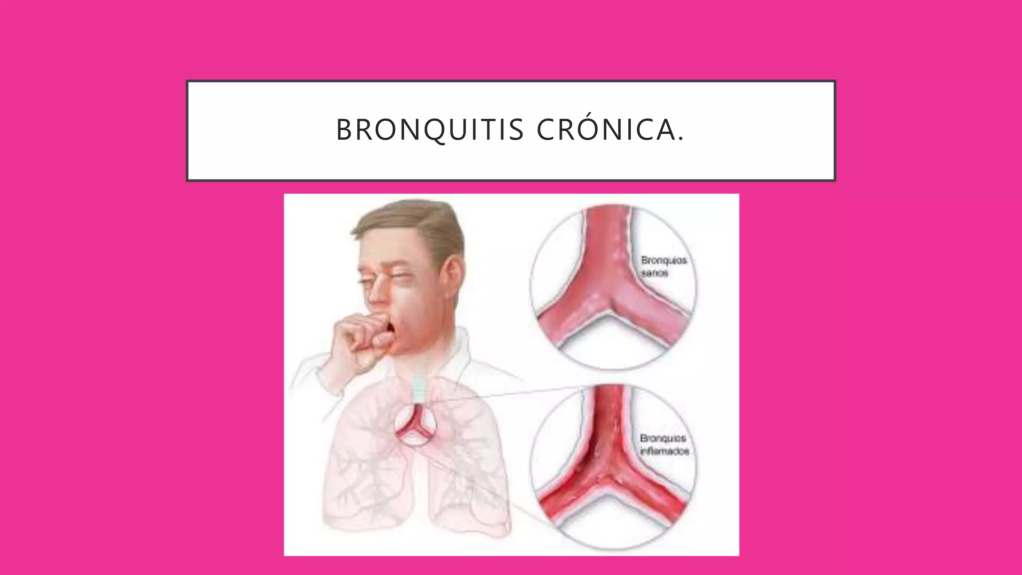 dx diferencial - bronquitis aguda (1).pptx