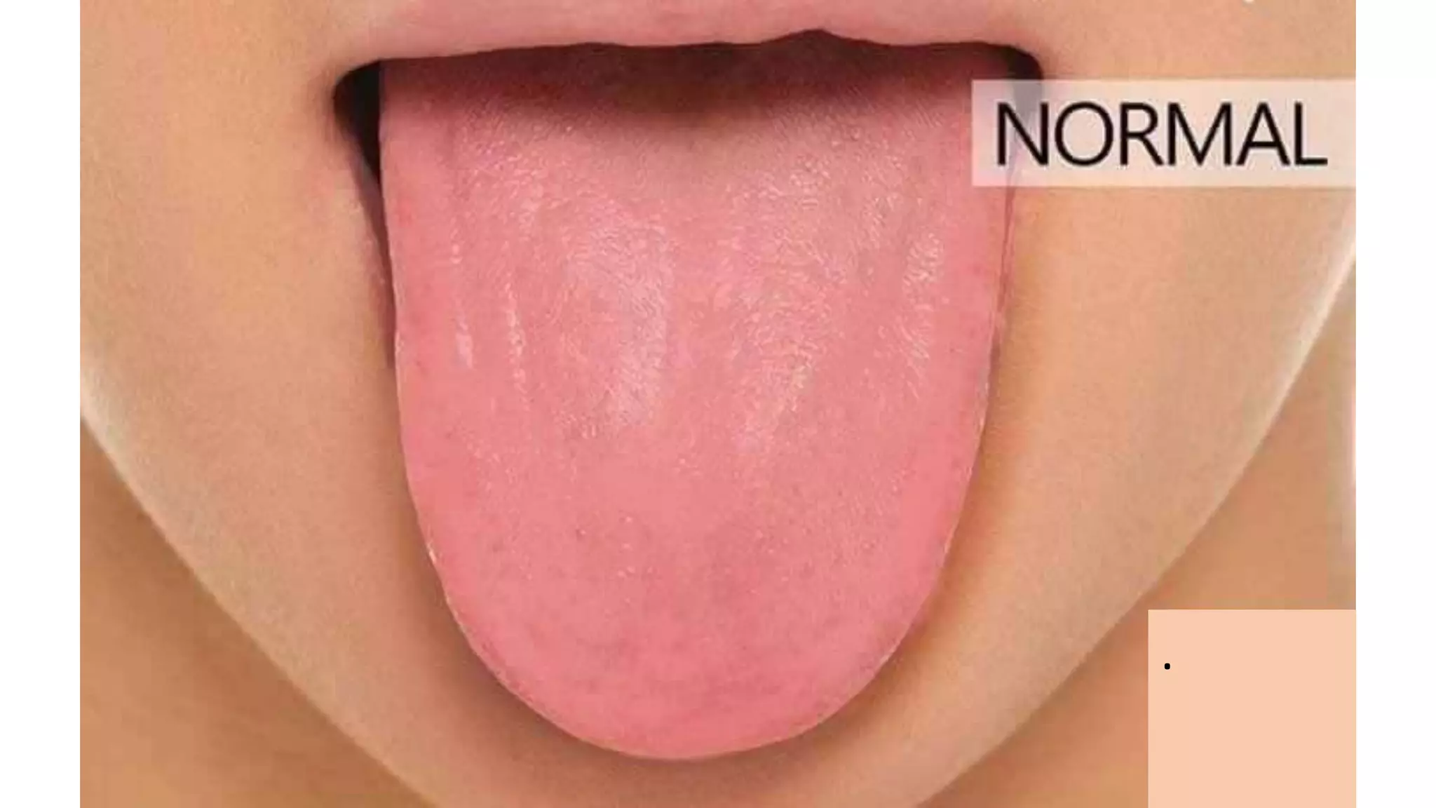 Tongue color changes in health conditions | PPTX