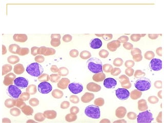 Diagnostic approach to CLL_Dr Nazim_PPT | PPT
