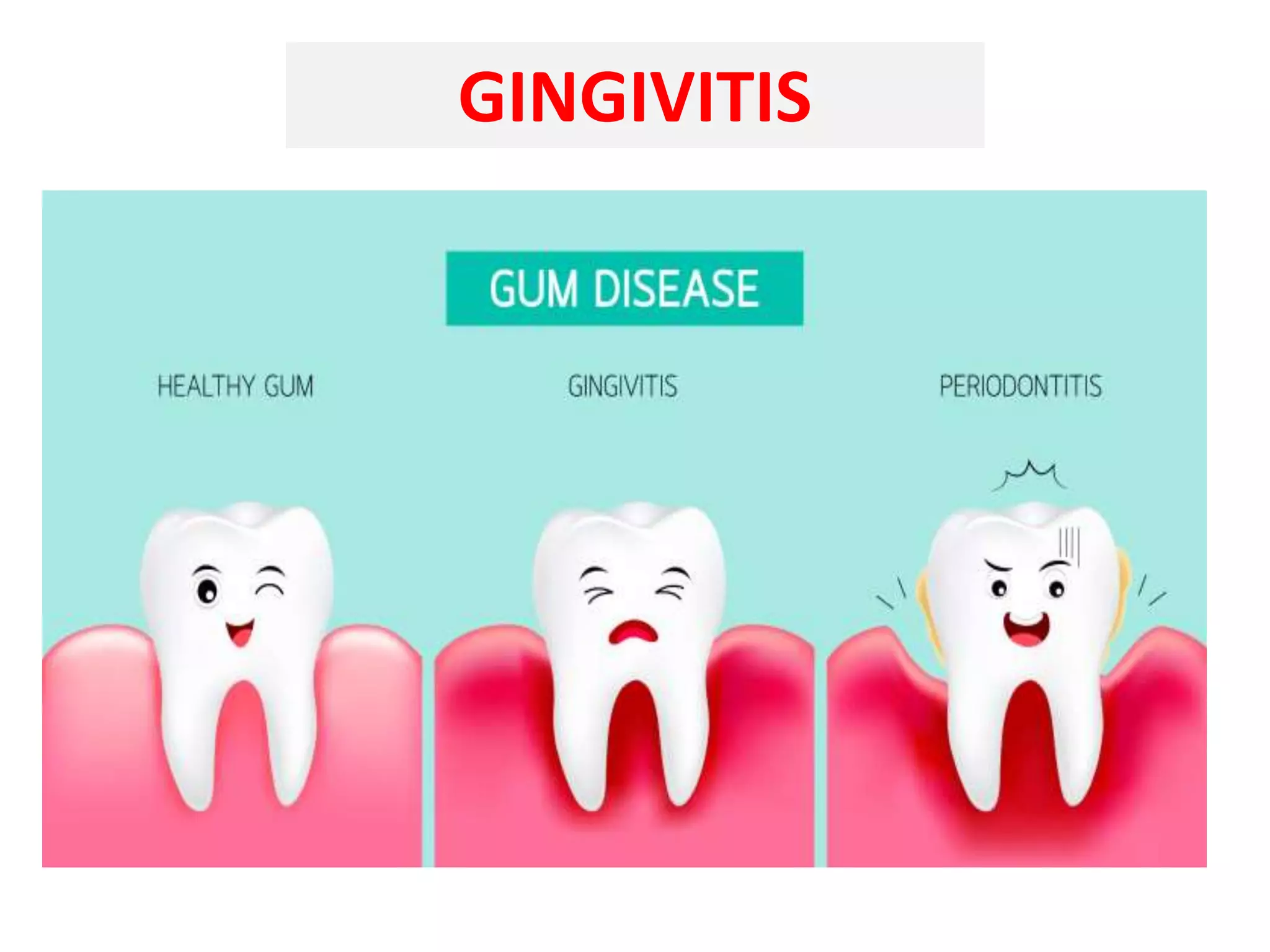 stomatitis, gingivitis, glositis | PPTX