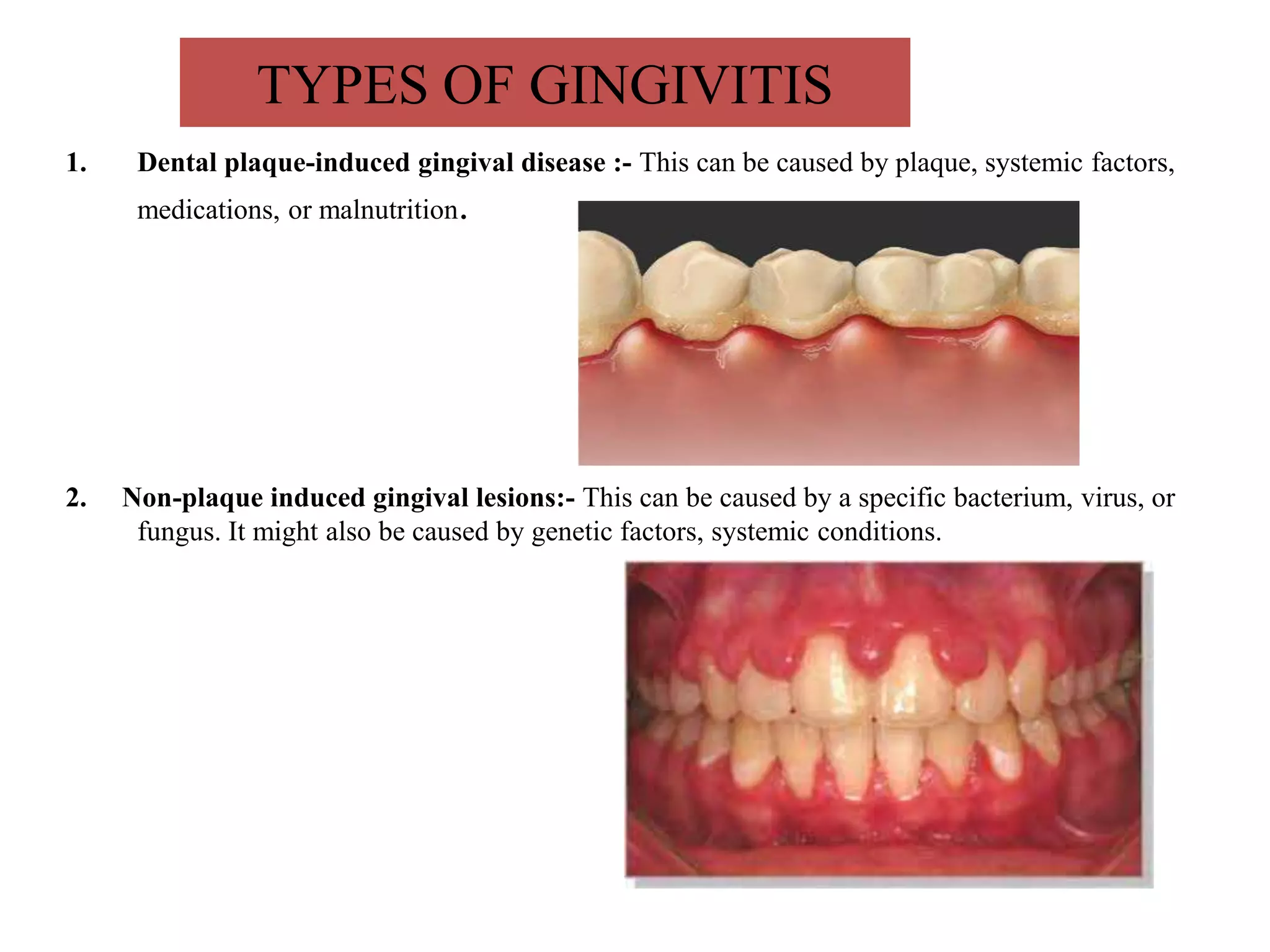 stomatitis, gingivitis, glositis | PPTX