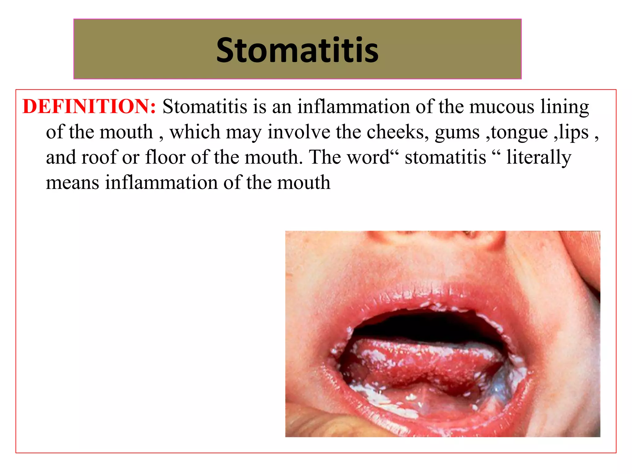 stomatitis, gingivitis, glositis | PPTX